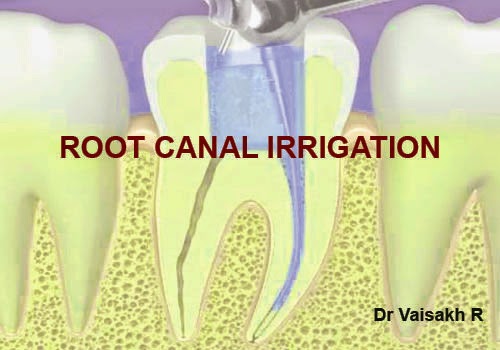 DENTAL MIRACLE .........: Root Canal Irrigations