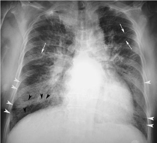 Edema Paru Akut Kardiogenik (Acute Cardiogenic Pulmonary Edema ...