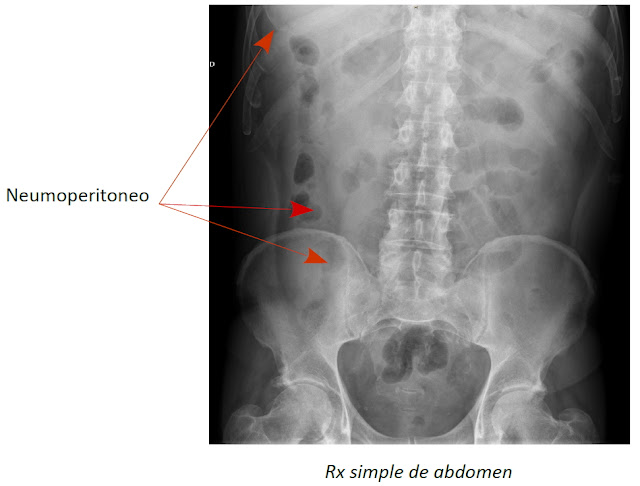 El Blog de Isa y Juan: Neumoperitoneo