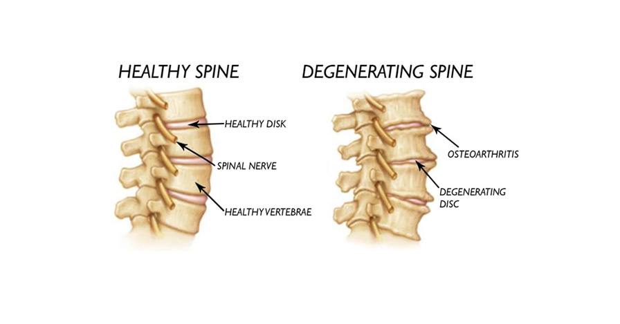 Common Types of Degenerative Spine Disease - MallikaSpine