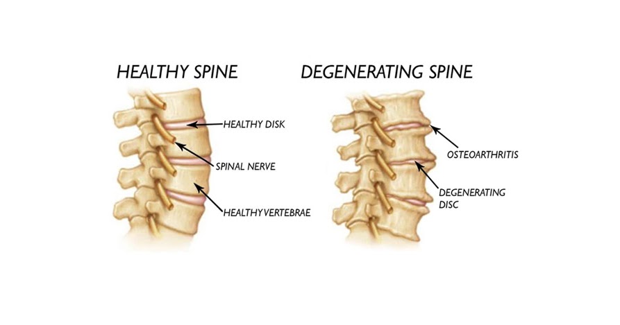 Common Types of Degenerative Spine Disease - MallikaSpine