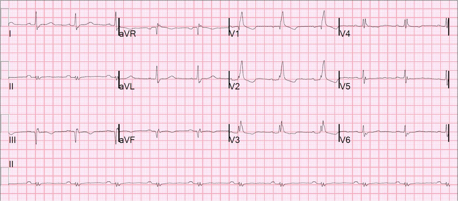 Dr. Smith's ECG Blog: Intermittent third degree heart block due to ...