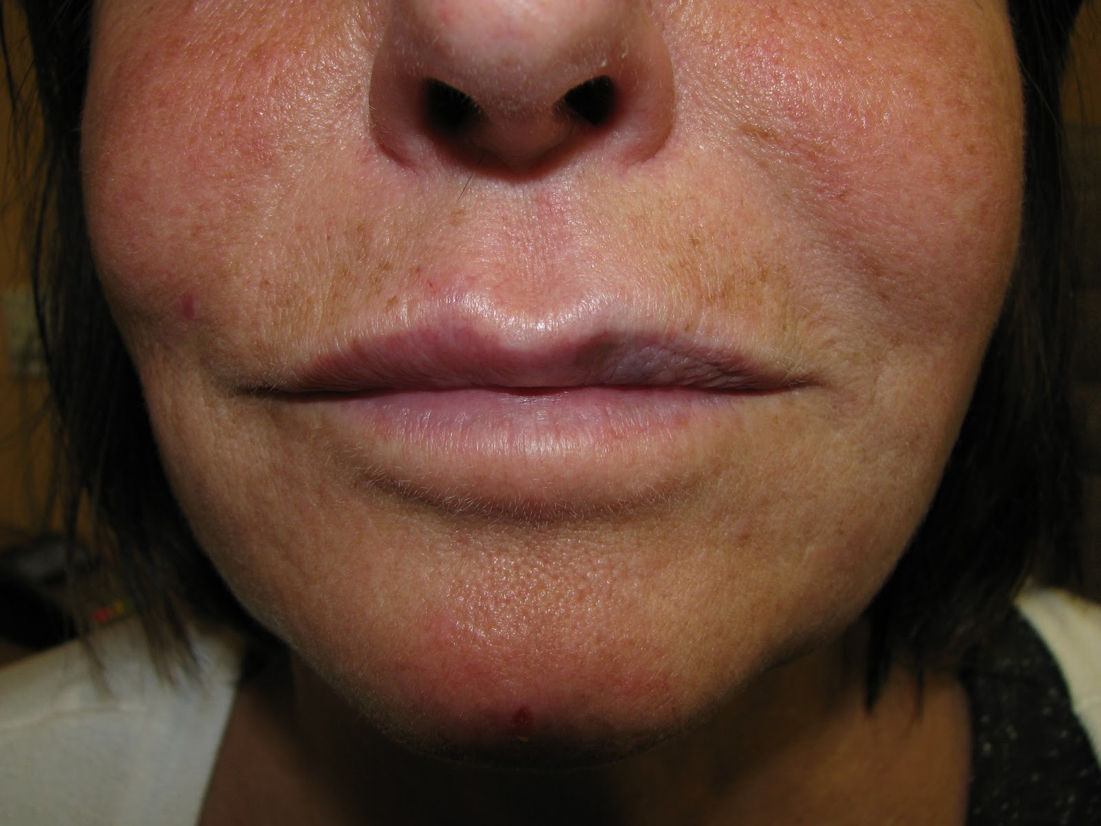 Selston Cosmetic Clinic: Youthful Looking Lips Using Dermal Fillers ...