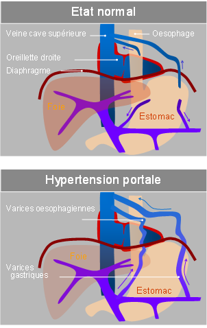 Les varices oesophagiennes (VO) | Récap' IDE