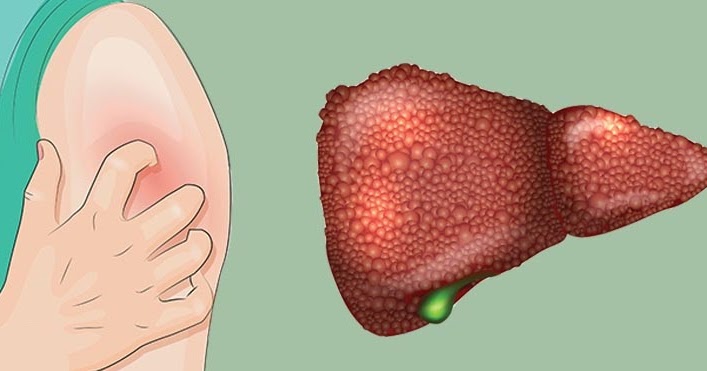 Bruise Easily? Itchy Skin? 5 Signs You Have Liver Damage Without Even ...