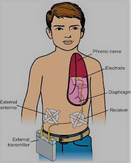 Congenital Central Hypoventilation Syndrome (CCHS)- Ondine’s Curse ...