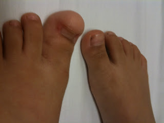 ORTHOPODY: Congenital foot deformities