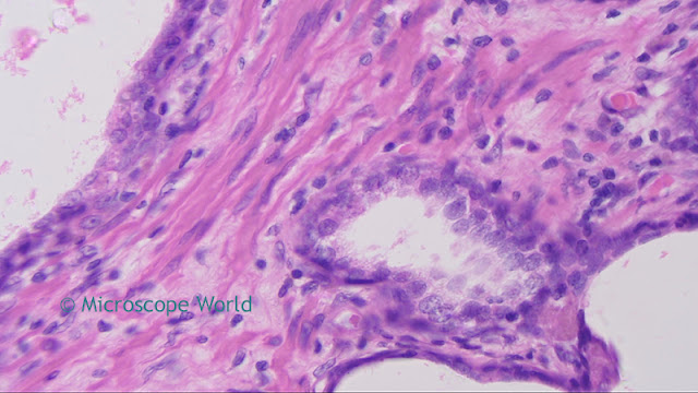 Microscope World Blog: Prostate Cancer under the Microscope