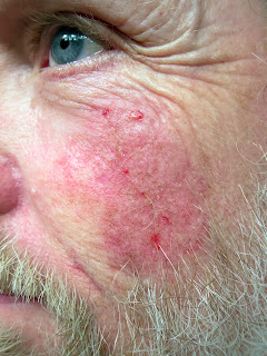 Efudex - Round Two: On my own for this experiment