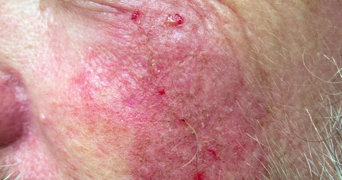 Efudex - Round Two: On my own for this experiment