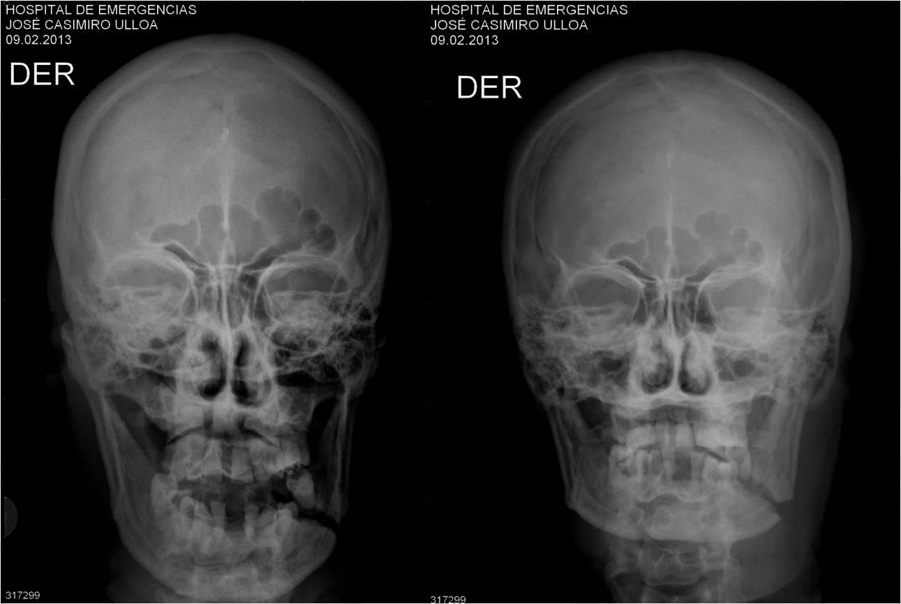 CASIMIRO RADIACTIVO: PASEANDO POR RAYOS X