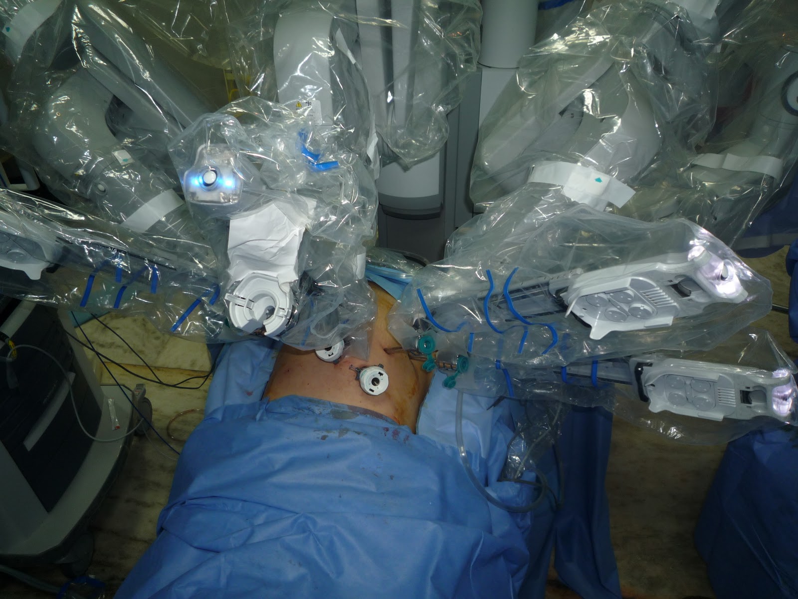 Return to India - incredible!: First robot assisted cystectomy in TN ...