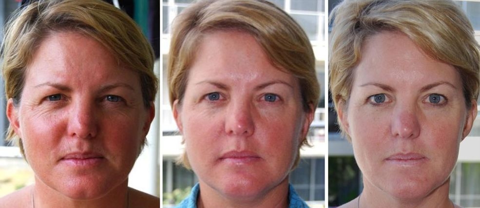Obtaining A Chinese Acupressure Facelift With Face Aerobics Workouts