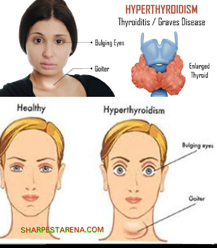 HYPERTHROIDISM: Causes, Signs, Symptoms, and Treatment.