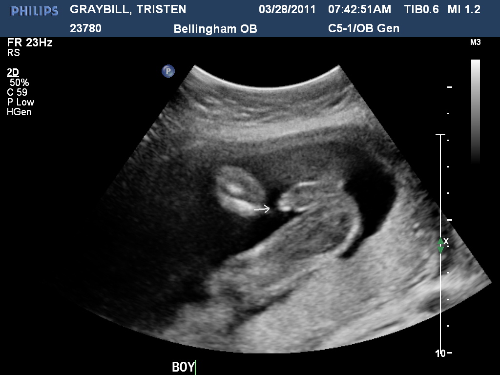 Inside Tristen: 20 Week Ultrasound: ITS A BOY!!