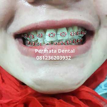Behel | Bracket | Kawat Gigi Fashion