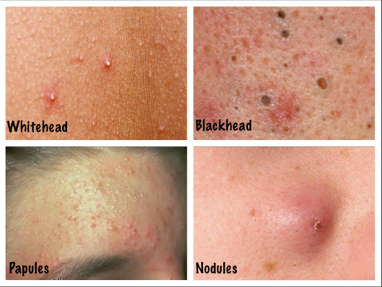 FAN MAIL FRIDAYS: The Difference Between Cystic Pimples and White- Eyed ...