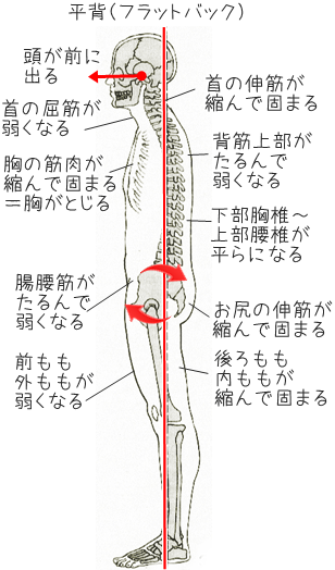 安部塾公式ブログ 身体操作指導者 安部吉孝 姿勢のゆがみの代表例(猫背反り腰・スウェイバック・フラットバック)と筋肉の関係