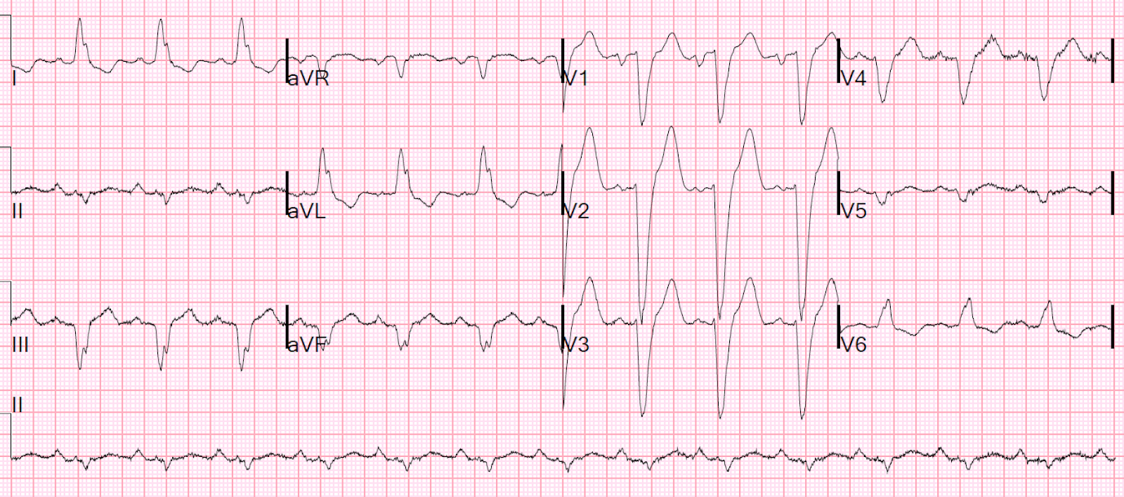 Pain In Left Side Of Chest But Ecg Normal at Lura Doty blog
