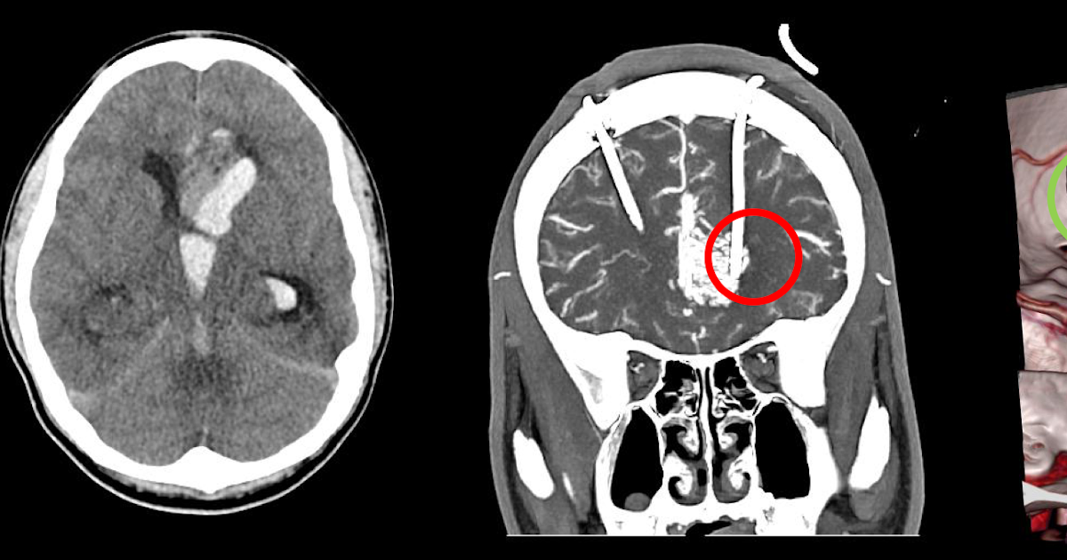 INTENSIVOS PEDIATRICOS: MALFORMACIÓN ARTERIOVENOSA (MAV) CEREBRAL EN ...
