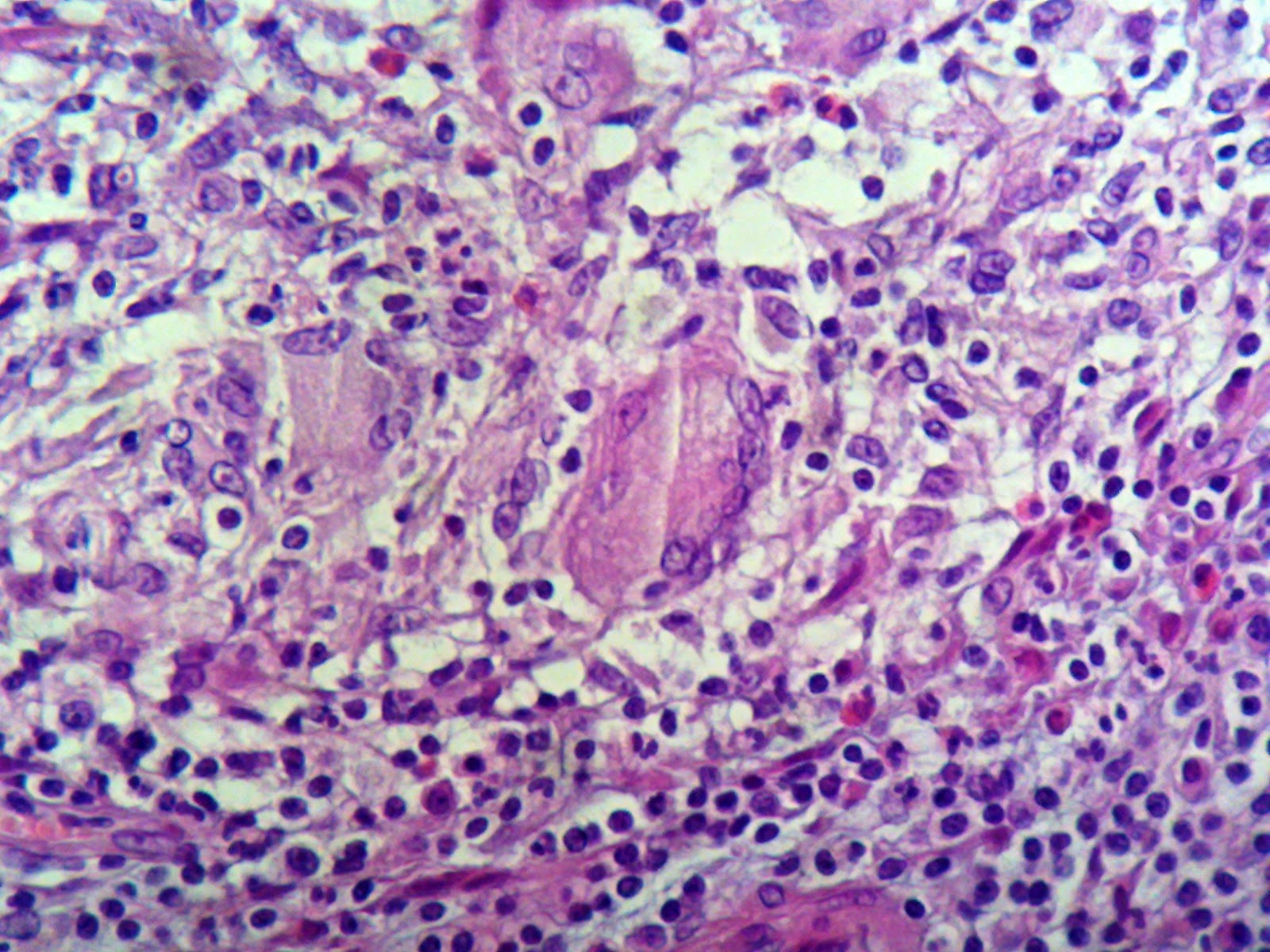 HISTOPATHOLOGY: Granulomatous Mastitis (Fungal)