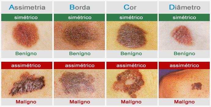Como suspeitar se uma pinta pode ser um melanoma