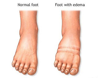 Physio knowledge BD: Peripheral edema