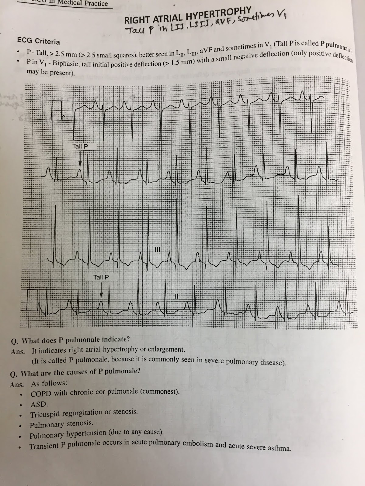 ECG RIGHT ATRIAL HYPERTROPHY