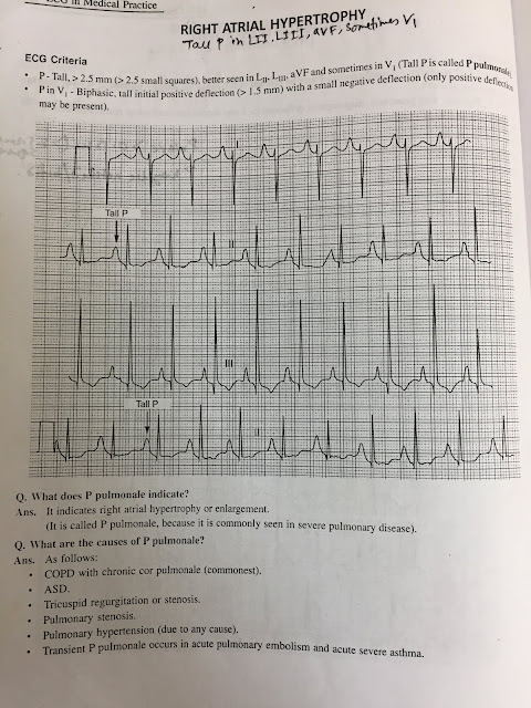 ECG RIGHT ATRIAL HYPERTROPHY