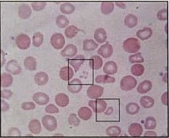 HEMATOLOGIA: ESQUISTOCITOS