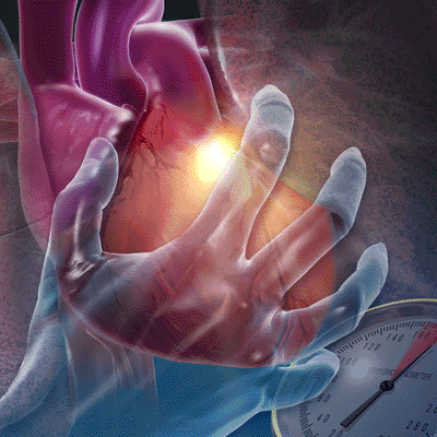 Medicina y algo más......: El Infarto de Miocardio