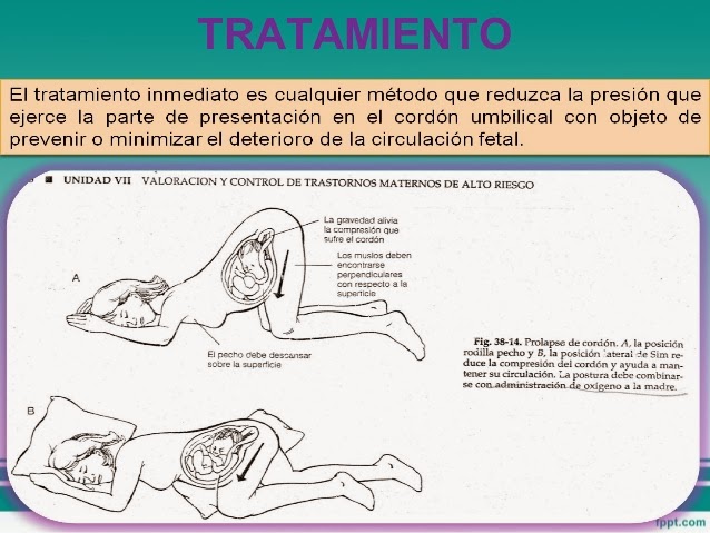 ¿Qué es un prolapso de cordón? | Matrona en Casa