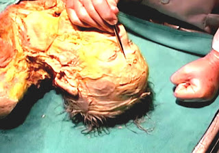 Dissection - Human Cadaver Dissection