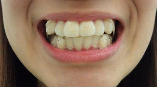 To a better smile - Invisalign!: Stretchy elastics and aligner #3!