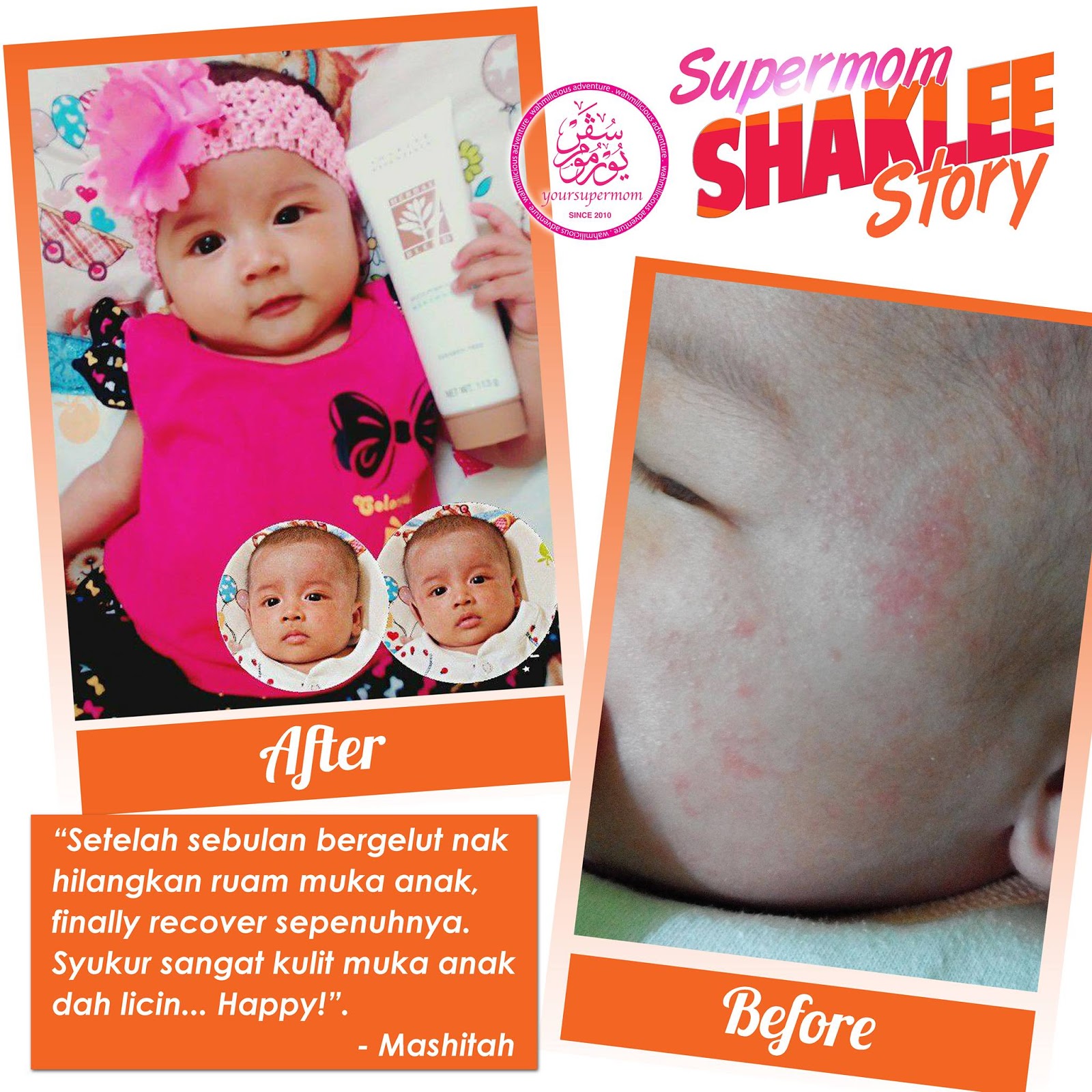 Ruam Baby Akhirnya Hilang, Kulit Muka Dah Licin | Umi Nazrah