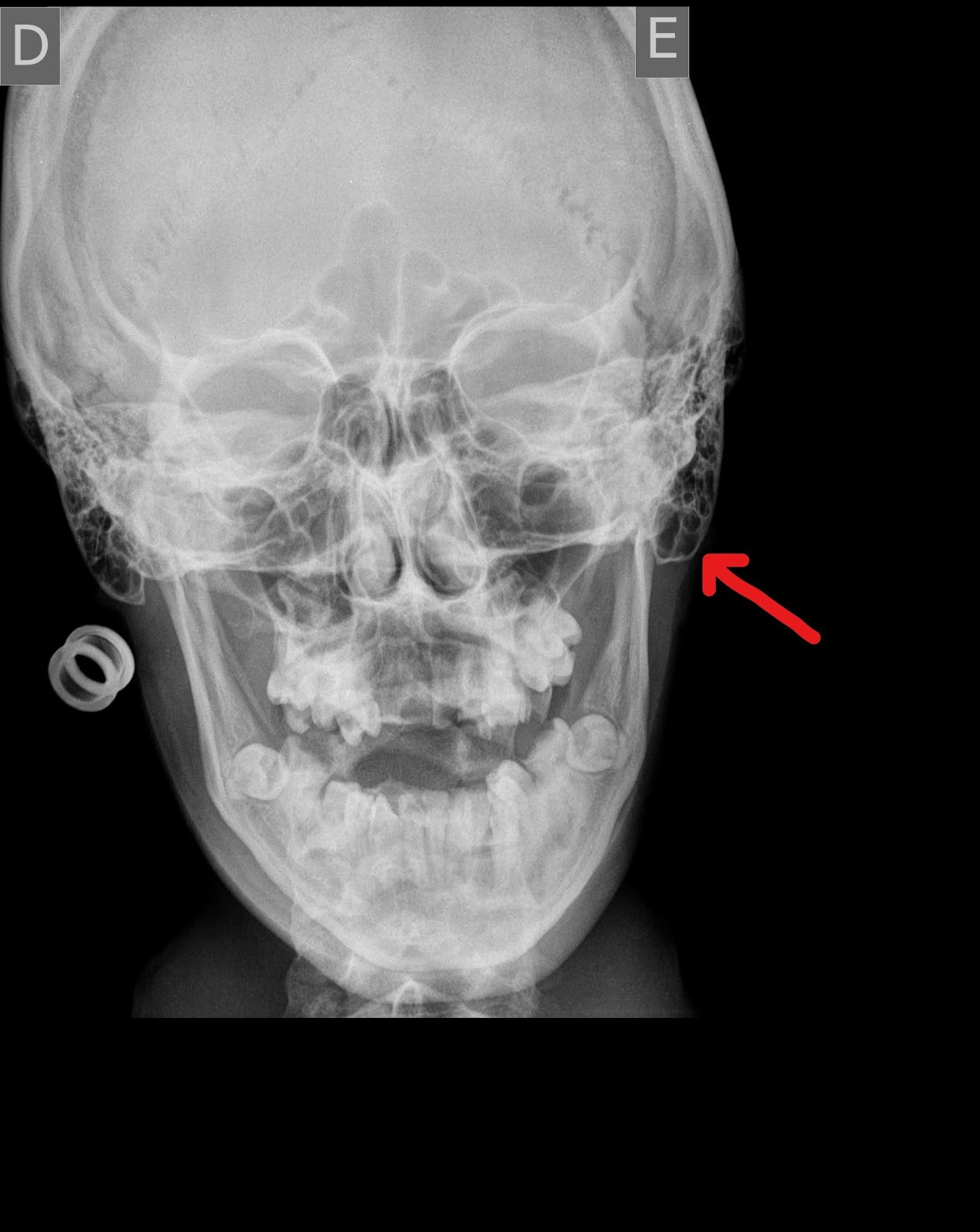 Traumatólogo de Guardia - Pedro Larrauri - Vigo.: Fractura de apófisis ...