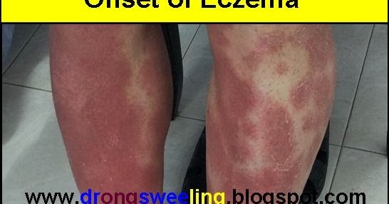 TCM News: TCM Physician Treat Symptoms of Severe Eczema with Natural Herbs