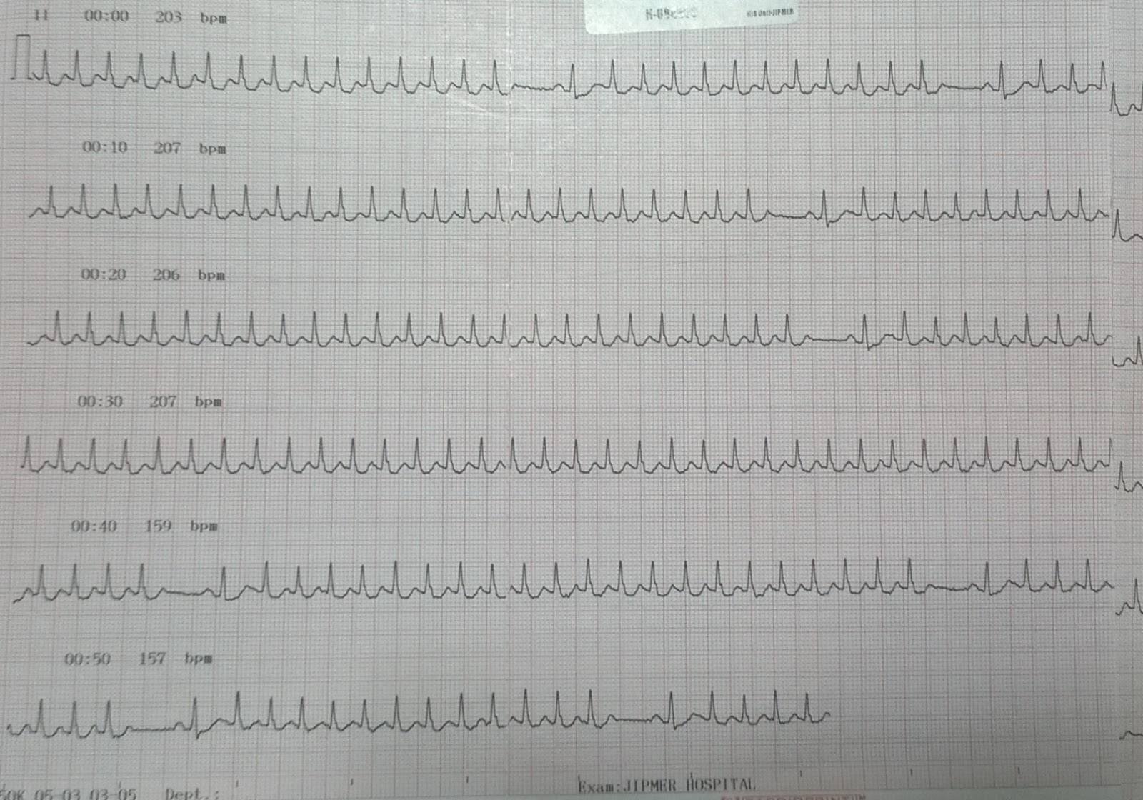 Cardiology window: Atrial tachycardia