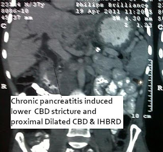 Dr. Keyur Bhatt - Gastrosurgeon: CASE: EXTREME CASE OF chronic ...