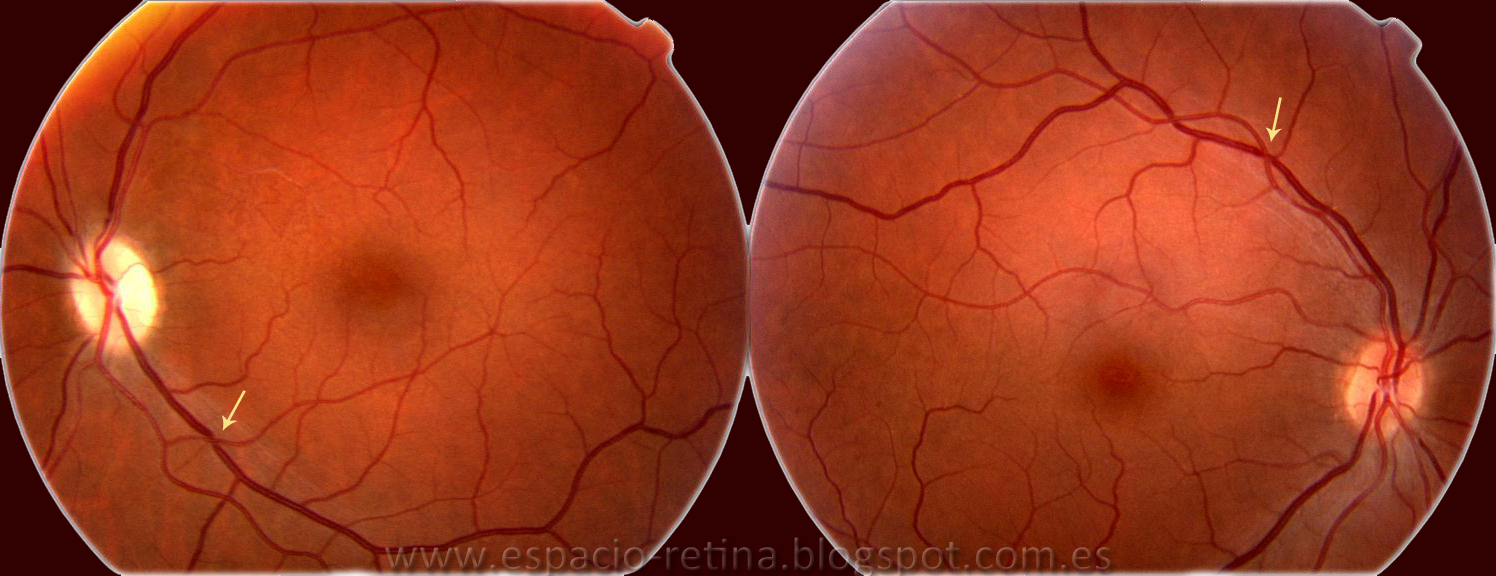 ESPACIO RETINA: Retinopatía HTA / Atrofia óptica.