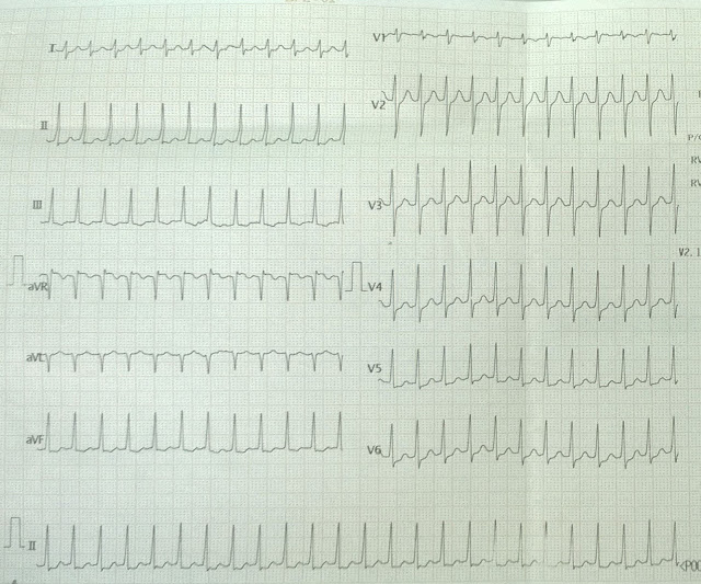 Cardiology window: PSVT
