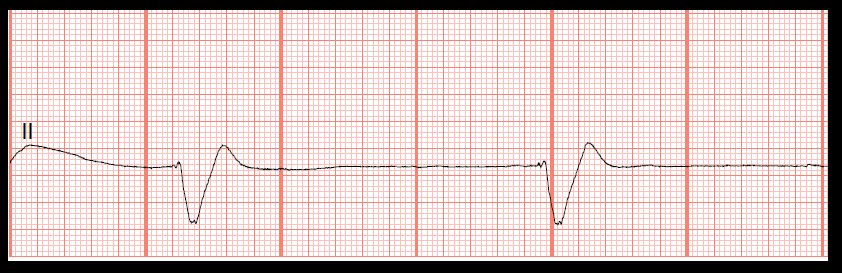 Practice EKG Strips 355