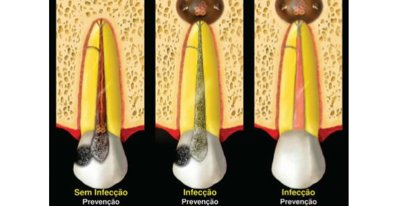 DúvidasOdonto: BIOPULPECTOMIA,NECROPULPECTOMIA E RETRATAMENTO