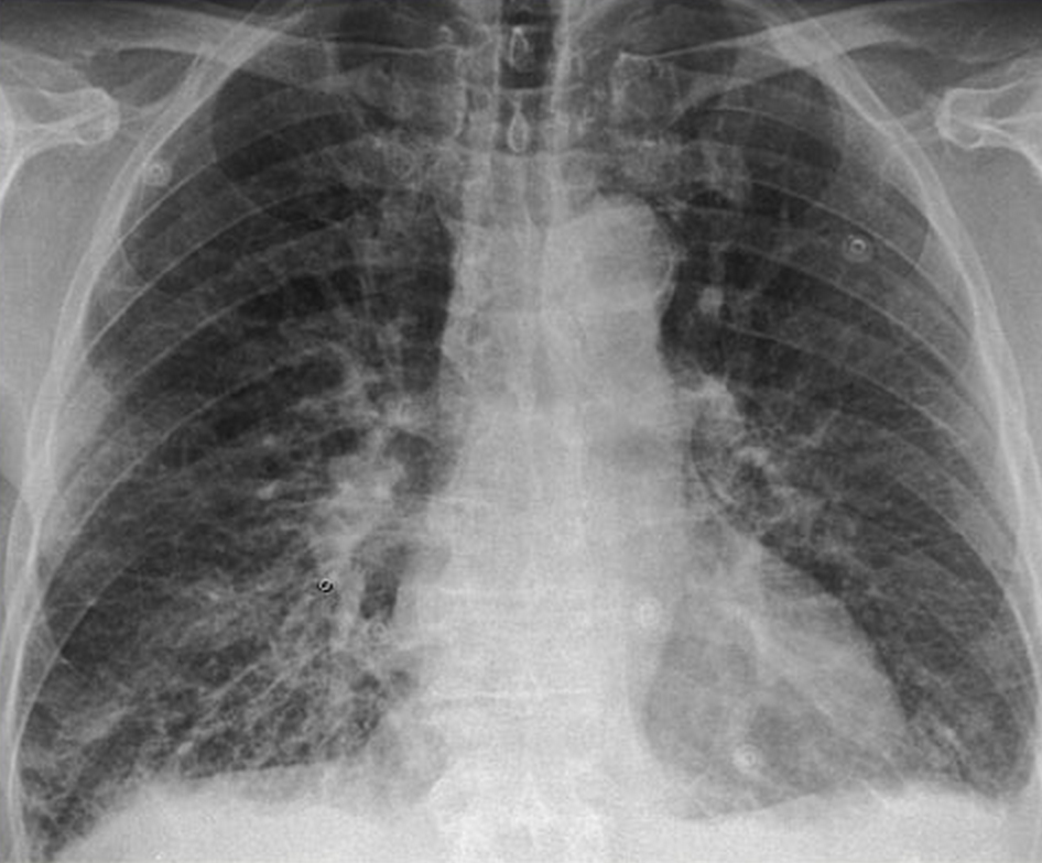 for the love of med school: Imaging Interstitial Lung Disease