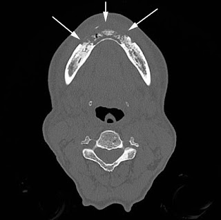 Roentgen Ray Reader: Bisphosphonate-related Osteonecrosis of the Jaw