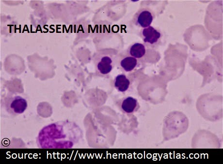 Lab Atlas: Thalassemia Minor