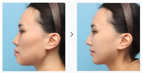 Kemolekan Hasil Operasi Dua Rahang Korea - SlideGossip