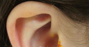 When Your Child Has a Draining Ear | Fauquier ENT Blog