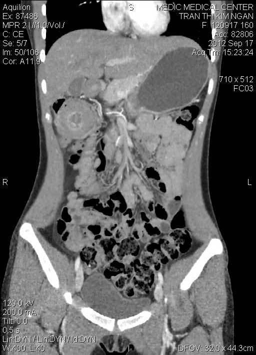 VIETNAMESE MEDIC ULTRASOUND: CASE 143: INTUSSUSCEPTION of COLON due to ...