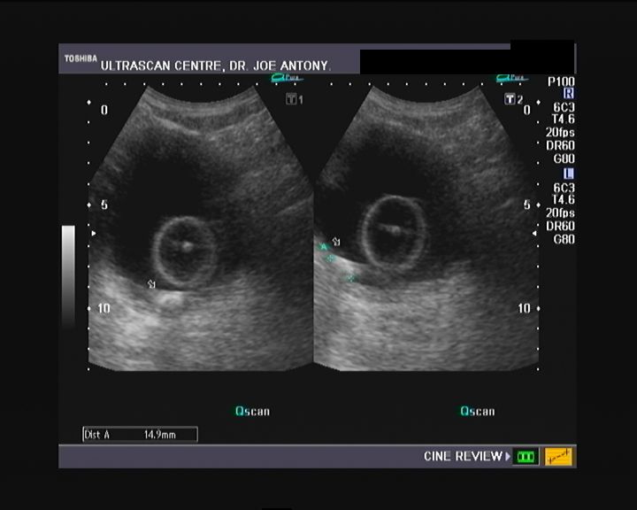 cochinblogs: Kidney stones- renal calculi- urinary stones